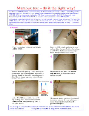 Fillable Online Mantoux test do it the right way Fax Email Print ...