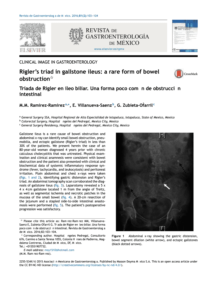 Fillable Online Rigler's triad in gallstone ileus: a rare form of bowel ...