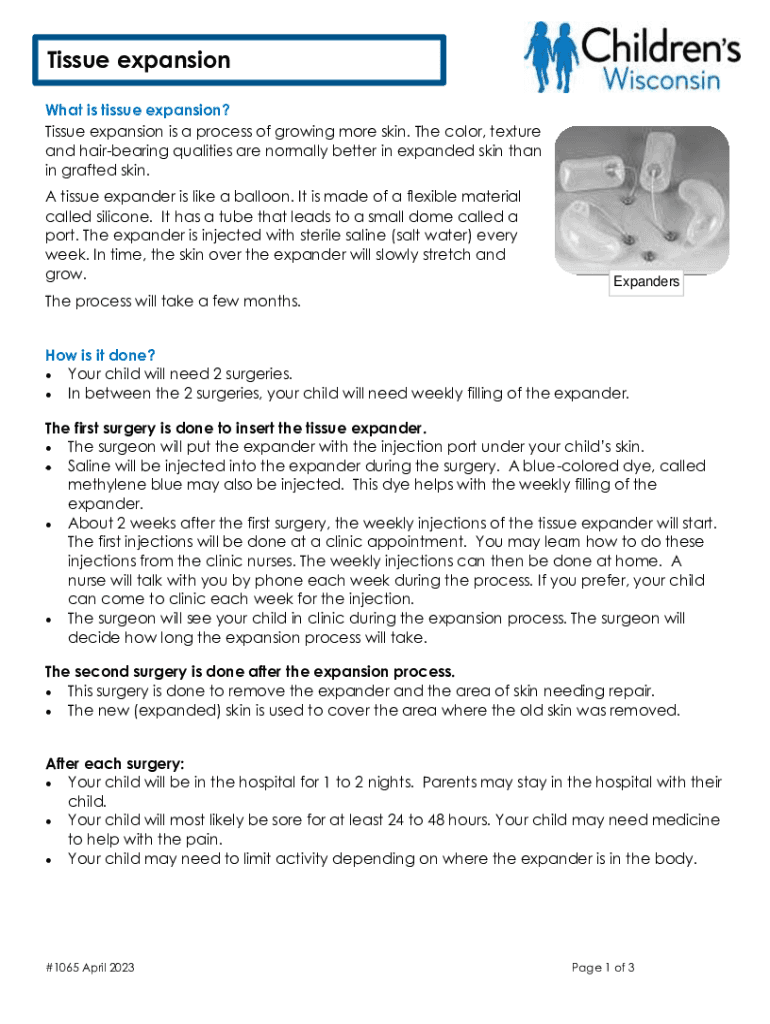 Fillable Online What is Tissue Expansion: Growing Extra Skin for ...