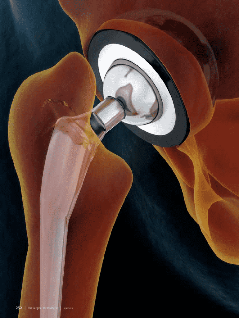 Fillable Online 3d Printing Aids Acetabular Reconstruction in Complex Revision Hip Arthroplasty ...